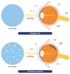 Seeing Flashes or Floaters? Get an Exam | Retina Associates of Kentucky