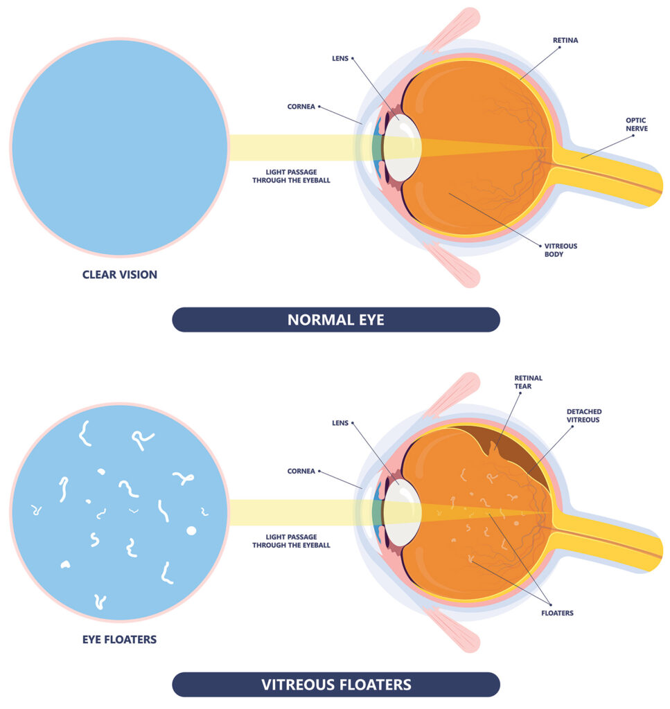 Floaters & Flashes Treatment in Kentucky| Retina Associates of Kentucky